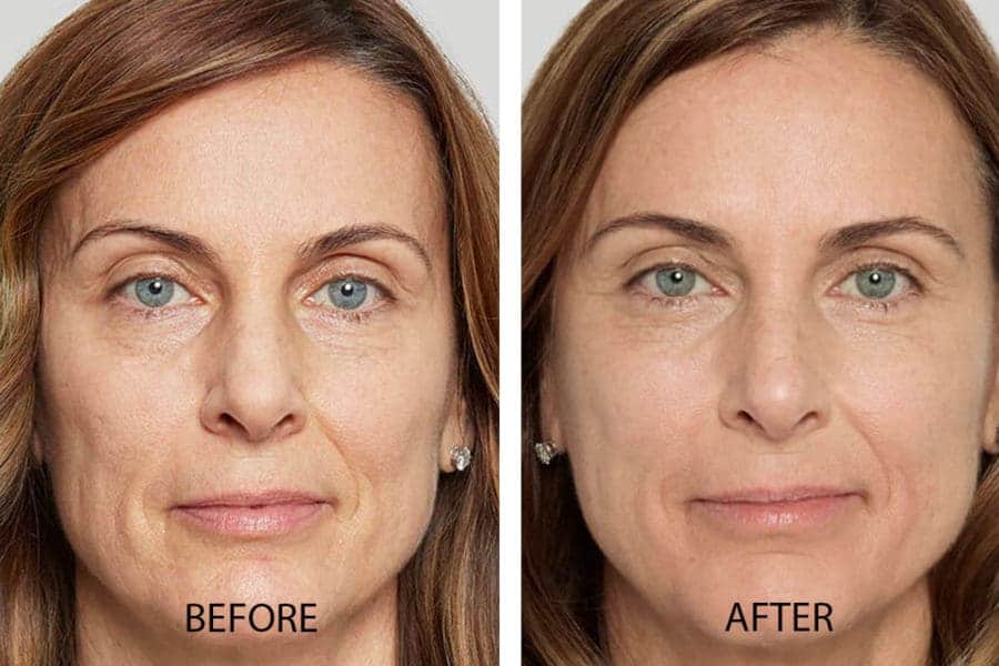 Sculptra Treatments in Beverly Hills, CA | LA Ageless